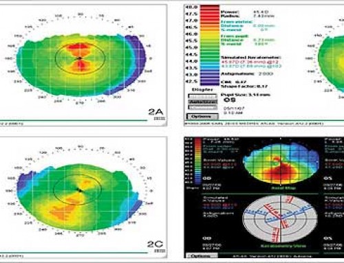 DIY TOOLS: How To Measure Your Astigmatism Diopters - Endmyopia